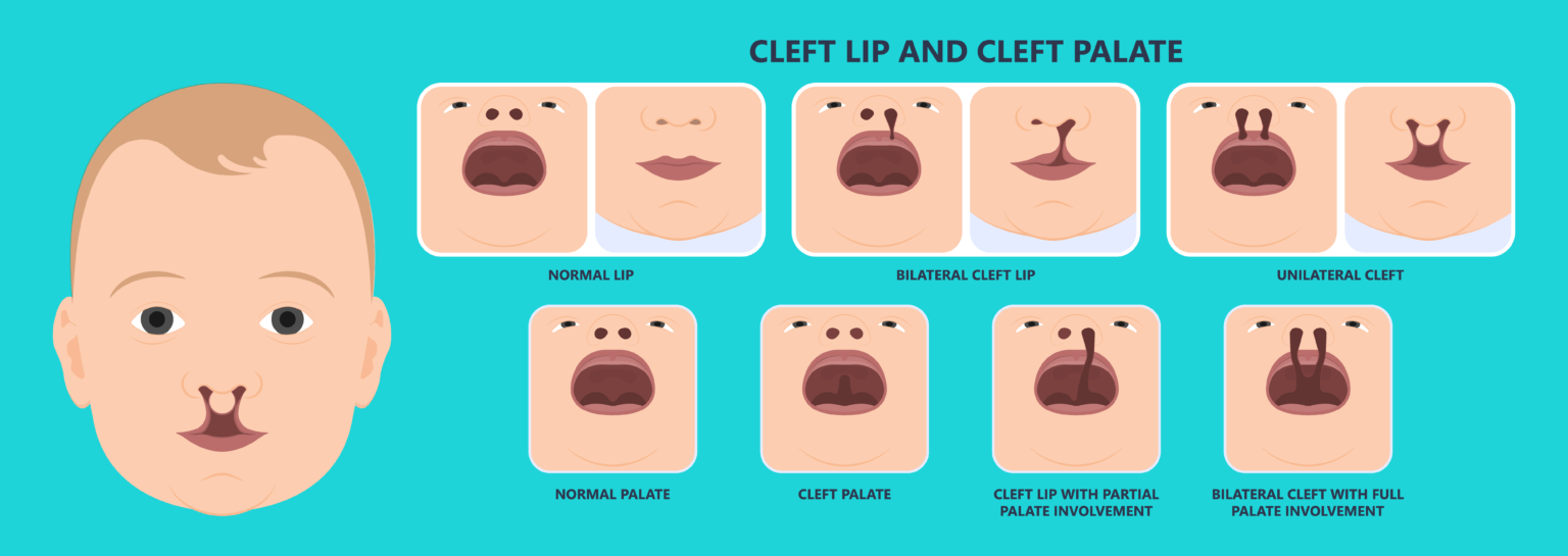 Cleft Lip or Cleft Palate - denTEL